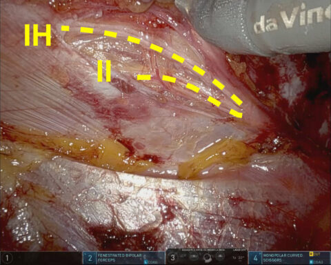 Dolor inguinal postoperatorio - Doctor Hernia